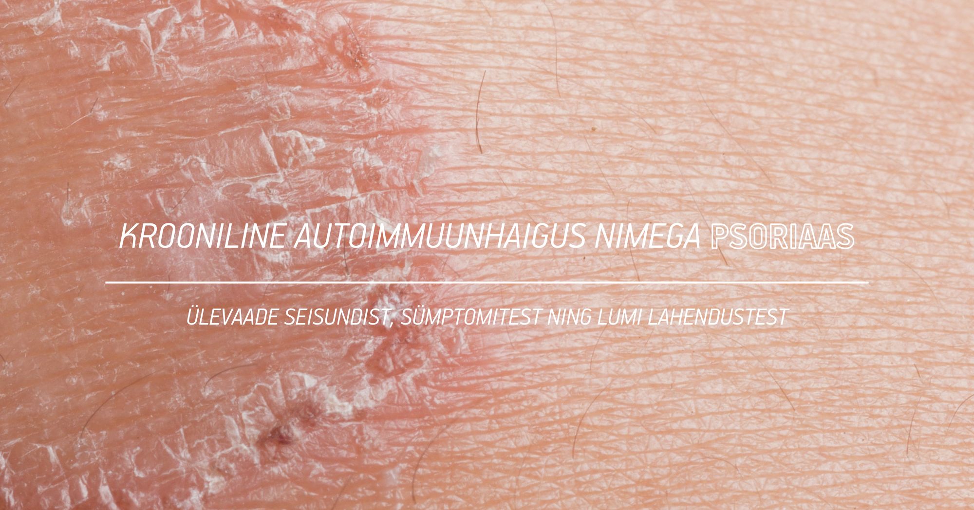 Hoia psoriaasi ilmingud kontrolli all LUMI abiga - Luminordic